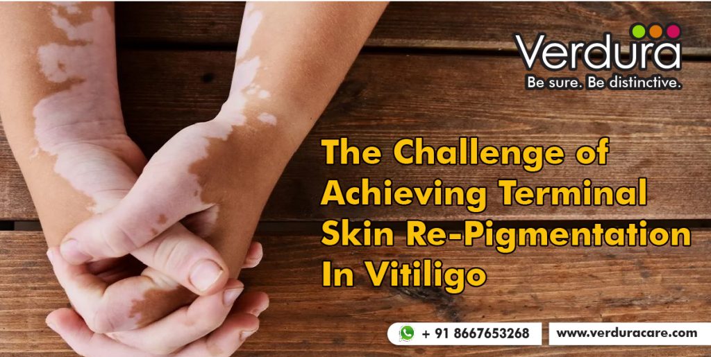 The Challenge of Achieving Terminal Skin Re-pigmentation in vitiligo ... The Challenge of Achieving Terminal Skin Re-pigmentation in vitiligo ...